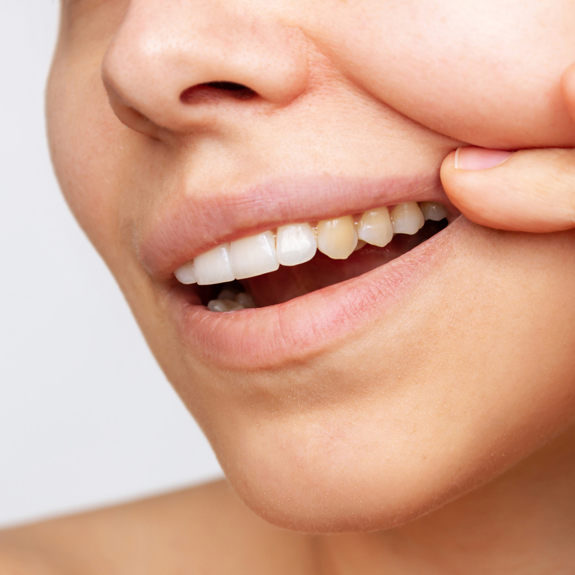 Yellow Teeth | Causes, Prevention, and Treatment Options
